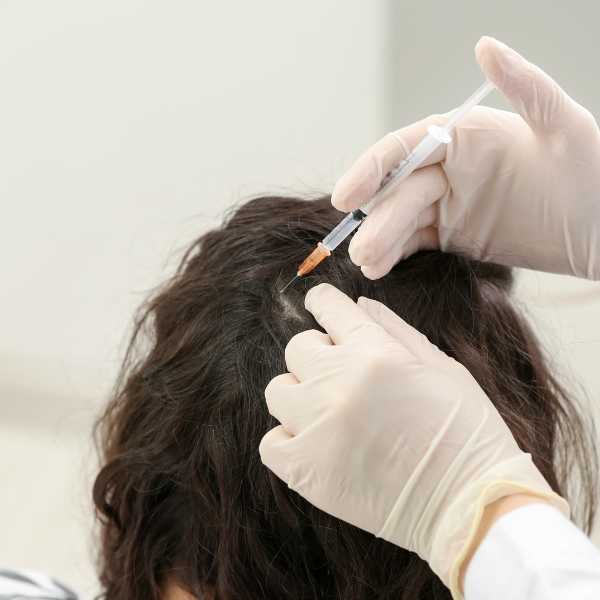 Injerto Capilar sin Rapar en Madrid ️ Precio