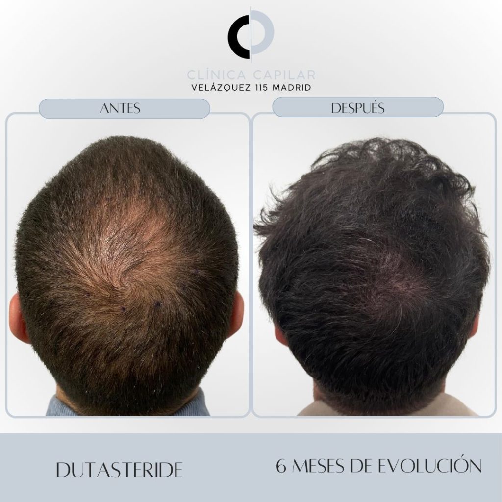 8 puntos principales del Dutasteride que debes saber - Clinica Capilar ...