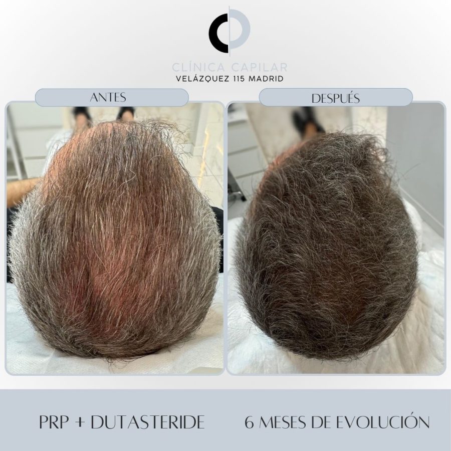 8 puntos principales del Dutasteride que debes saber - Clinica Capilar Velazquez